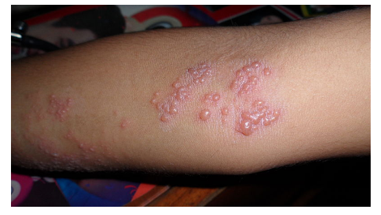 Inimesel levinumad viirushaigused, AIDS